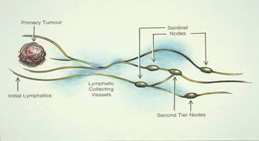 Sentinel Node Biopsy – NZMU