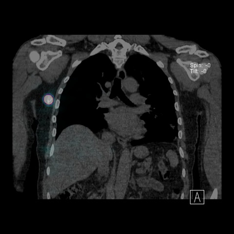 Sentinel Node Biopsy – NZMU